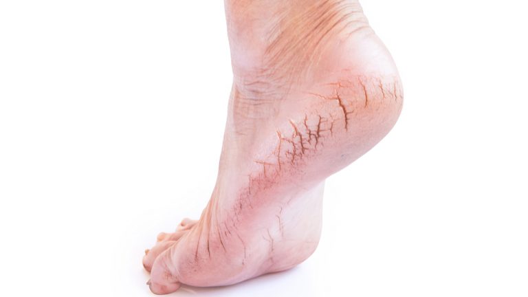 Cele mai eficiente tratamente naturale împotriva bătăturilor | avantaje.ro