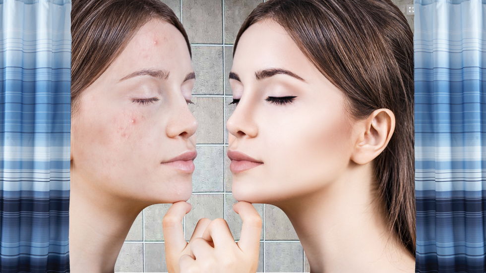 Top 10 remedii naturale pentru acnee și pentru îndepărtarea ...