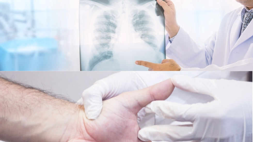 Semnele apărute la nivelul mâinilor care pot anunța cancerul pulmonar