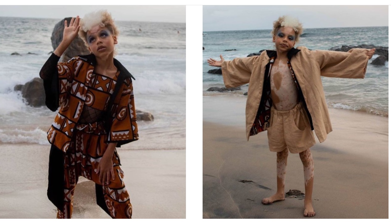 Samuel Silva, supermodelul care suferă de o afecțiune rară a pielii