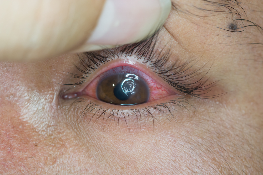 Ce este un infiltrat cornean? Cum se tratează?