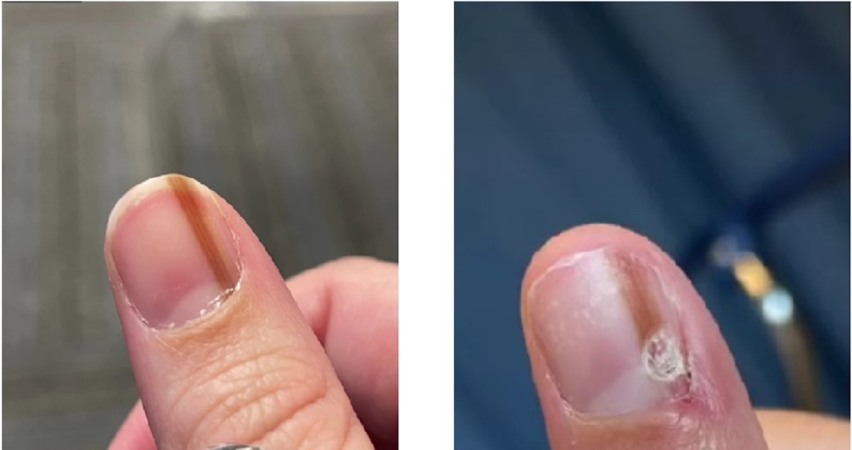 Surpriza pe care a avut o femeie când a aflat ce avea pe unghie